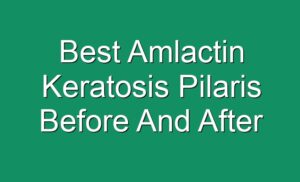 Best Amlactin Keratosis Pilaris Before And After